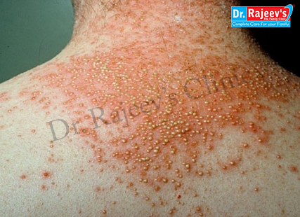 Picture Of Ringworm Of The Groin Tinea Cruris