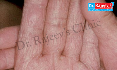 Homeopathy Treatment for Ringworm, Fungal Infection Treatment