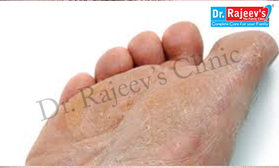 Homeopathy Treatment for Ringworm, Fungal Infection Treatment